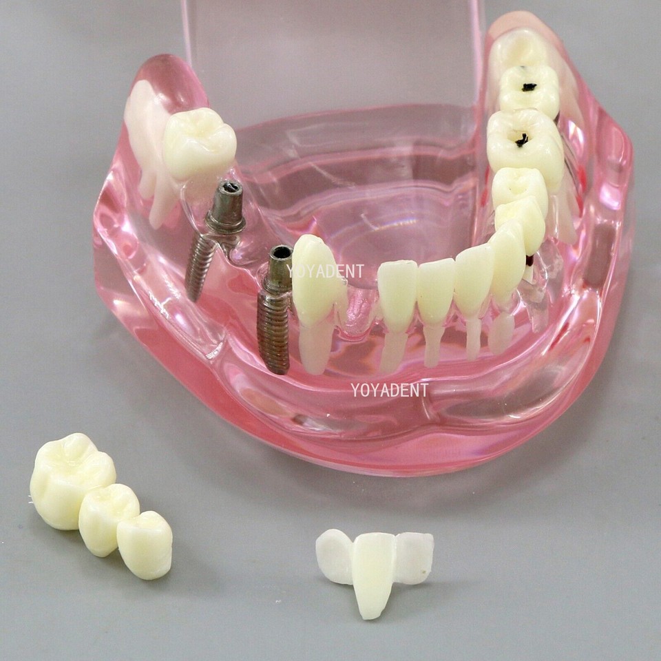 Dental teeth Model Preparation Training Teaching Ortho Implant Typodont ...