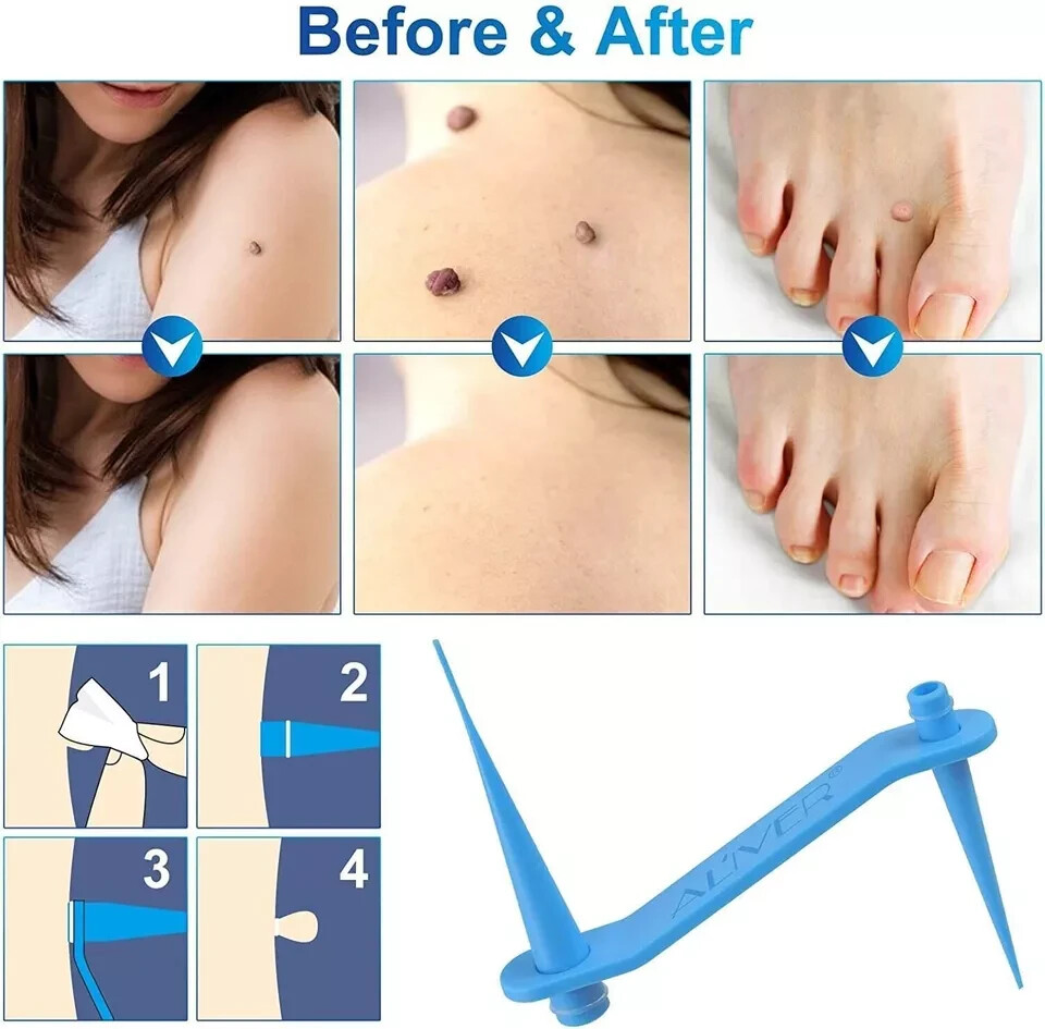 Rubber Bands Skin Tag Remover Skin Tag Removal Kit Mole Wart Tool Face ...