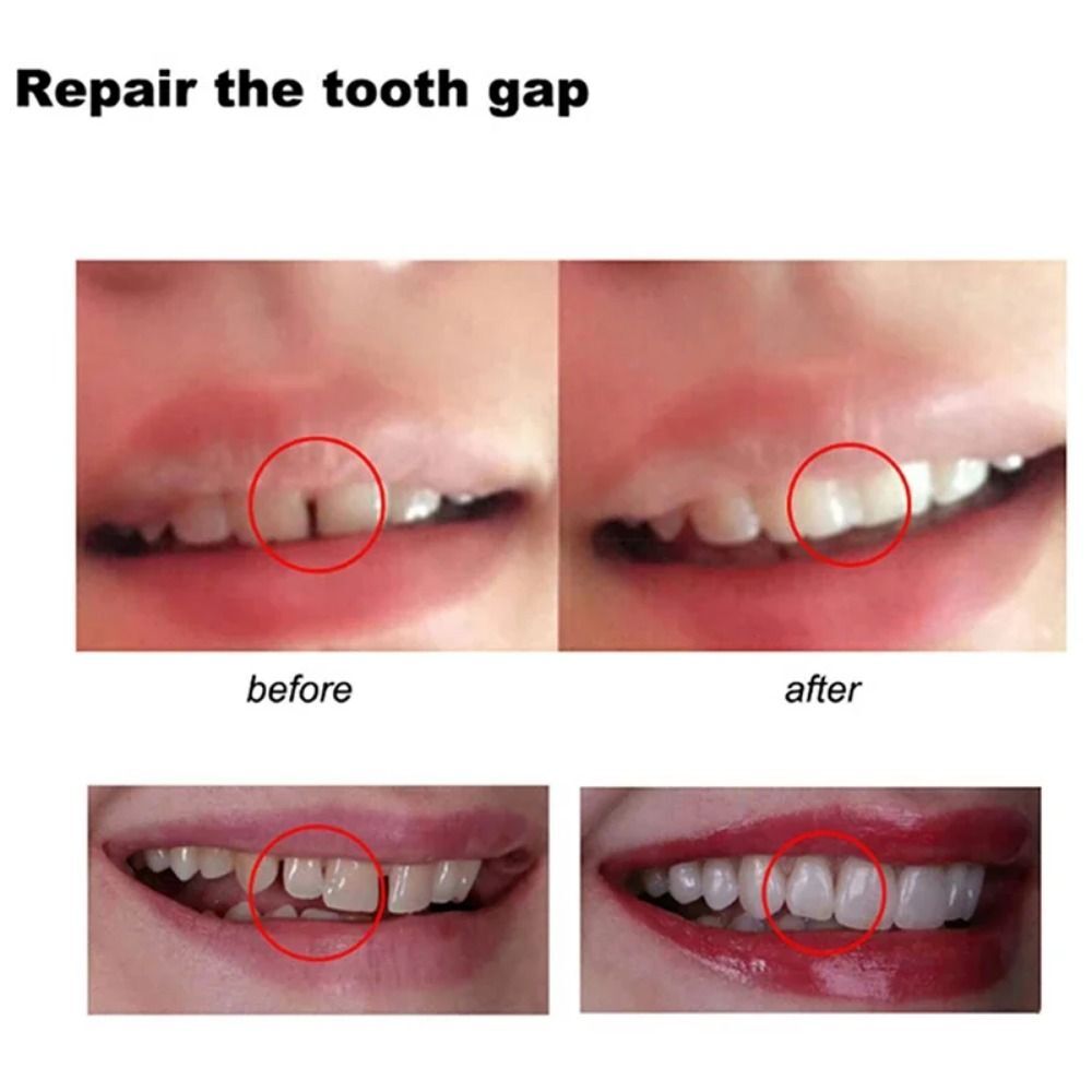 Tooth Repair Glue Teeth Gaps Filling Solid Shapeable Falseteeth Glue ...