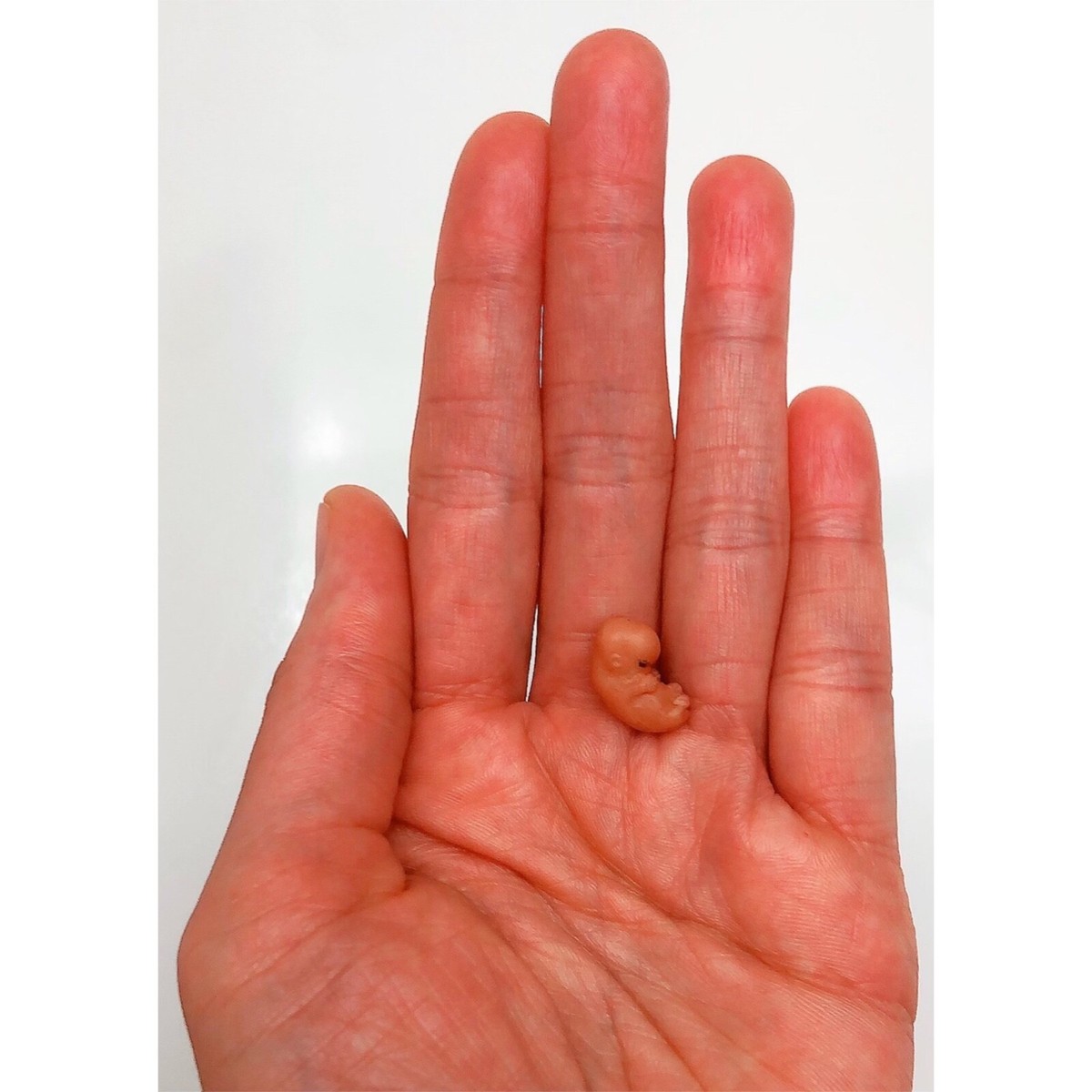8 Week Miscarriage Pictures 8 Weeks Pregnant | BabyCentre