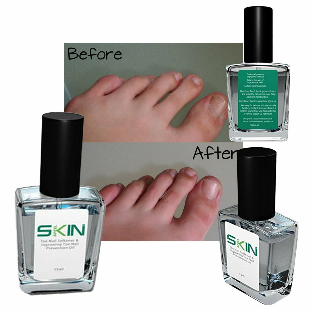 TOE NAIL SOFTENER | Softens Ingrown Toenail Treatment Oil for Hard ...