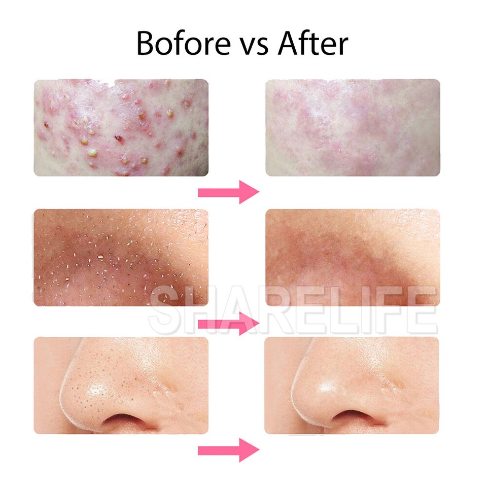 8Pcs Set Blackhead Extractor Tool Remover Pimple Blemish Comedone Kit ...