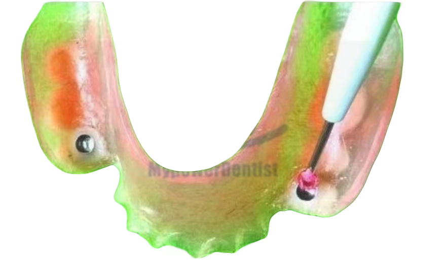 Overdenture Male Caps Dental Castable Ball Metal Housing Retention ...