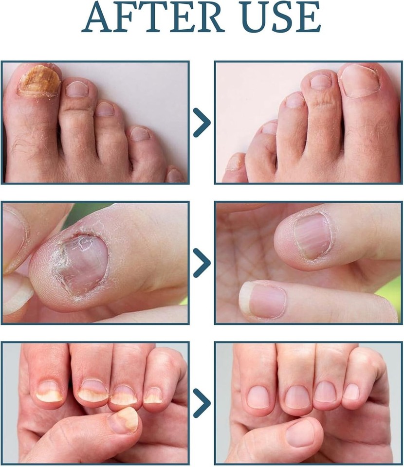 Fungal Nail Treatment - Extra Strong Nail Fungus Treatment for Toenail ...