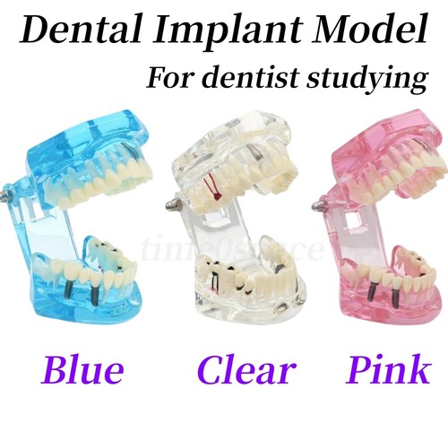 Teeth Model Dental Typodont Ortho Implant Pathological Perio Practice ...