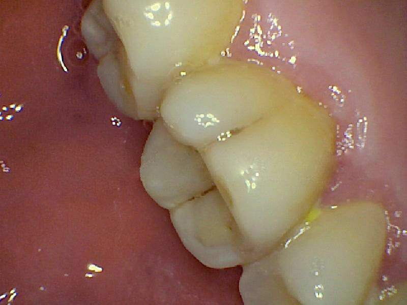 New Dentist Dental 5.0MP USB IntraOral Oral Camera HK790 LED+Software ...