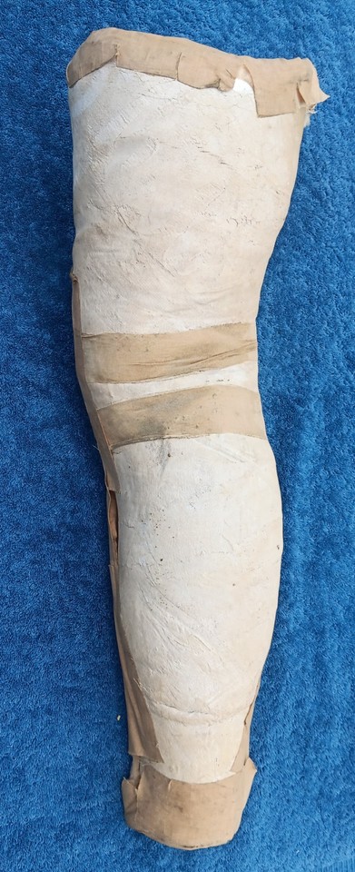 Vtg Plaster Human 1964 Mans Broken Leg Cast Orthopedics Hospital No ...