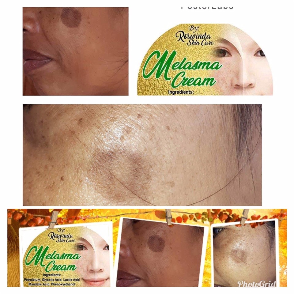 Melasma Cream Remove Dark Acne Sun Spot Melasma Hyperpigmentation Best ...