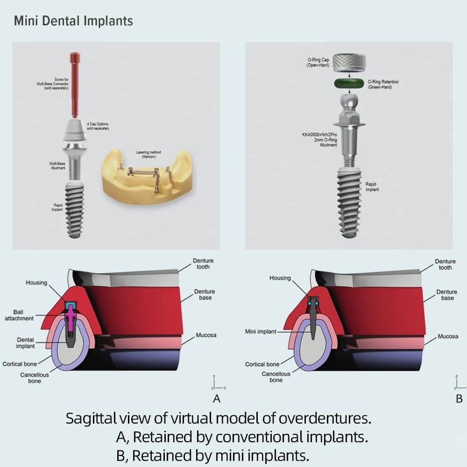 O-Ring Mini Dental Implants Replacement 3 Convenient Sizes with Tool ...