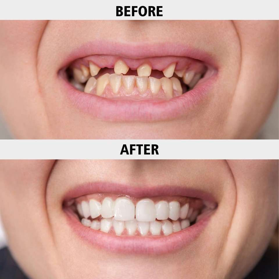 DIY Denture Repair Kit Soft Resin False Teeth for Fixing Missing Teeth ...