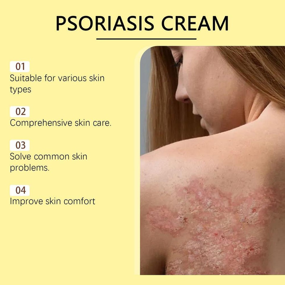 Psoriasis Cream Dermatitis Pruritus Eczema Ointment Skin Anti Itching ...
