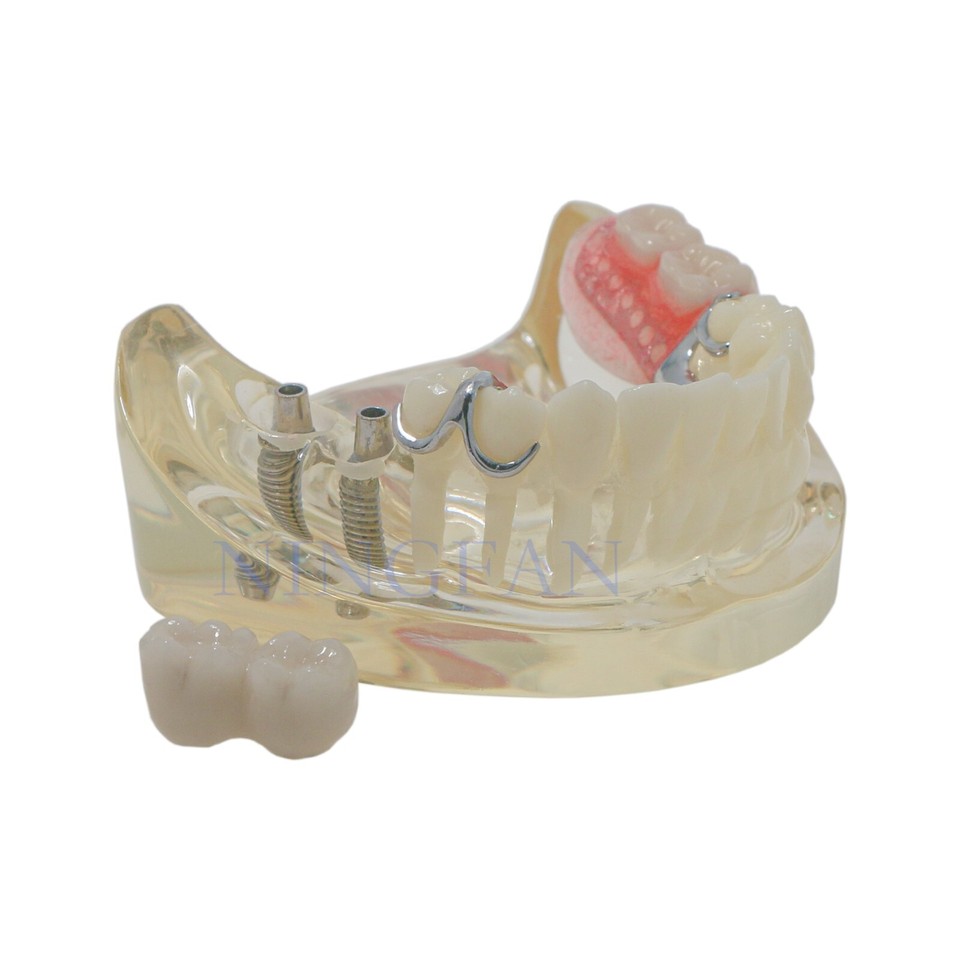 Dental Typodont Removable Partial Denture Model ,PRD Telescopic Crown ...