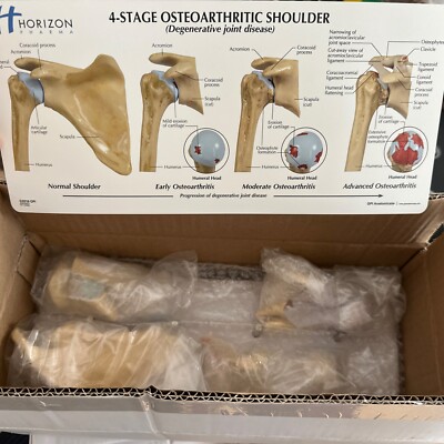 Degenerative Joint 4 Stages Of Osteoarthritis Osteoarthritic Shoulder ...