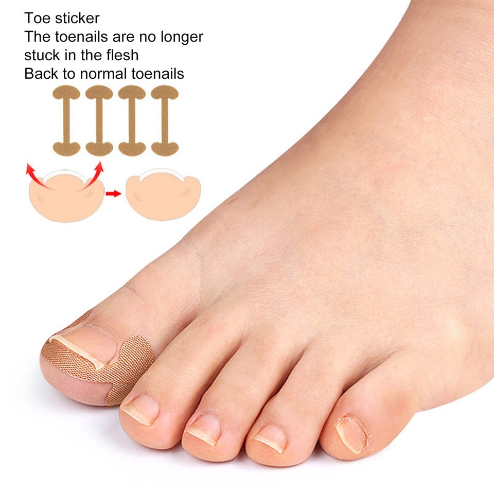 1 Set Toenail Correction Patch Patch Strips Nail Adjuster Curved ...