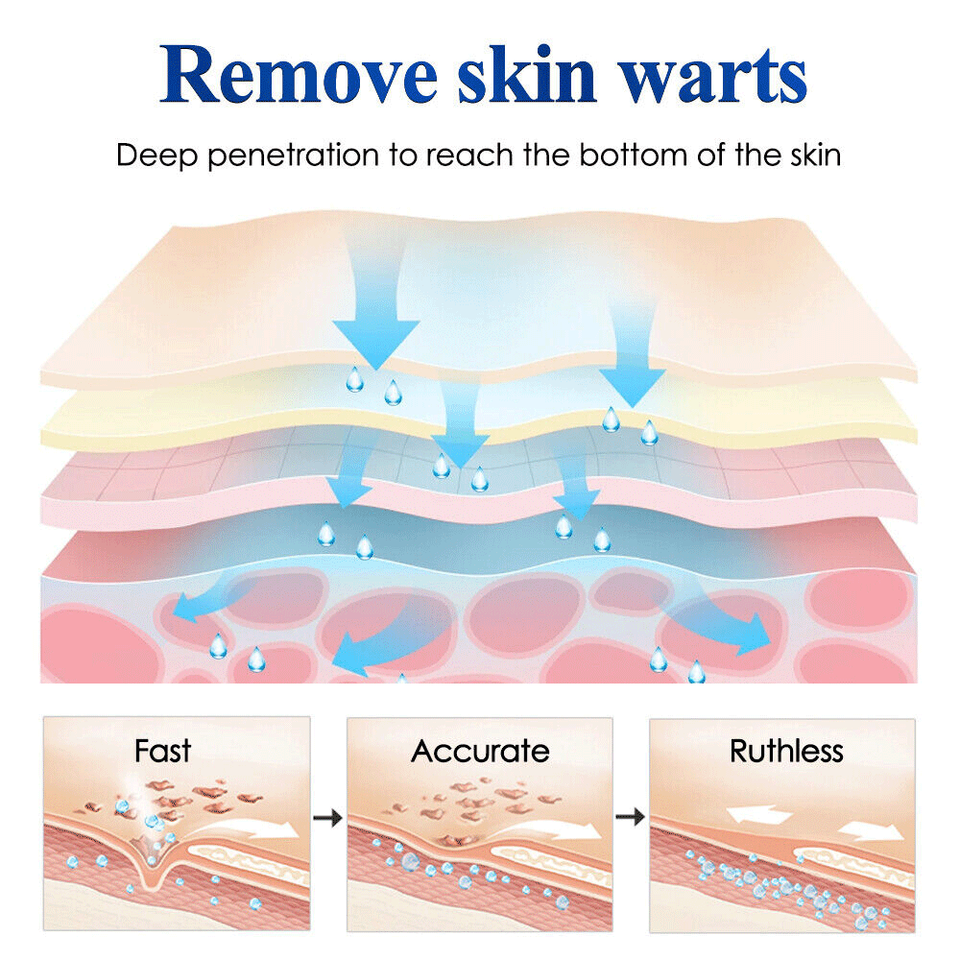 Wart Remover Liquid Skin Tag Mole Remover Eliminate Feet Corn Wart ...