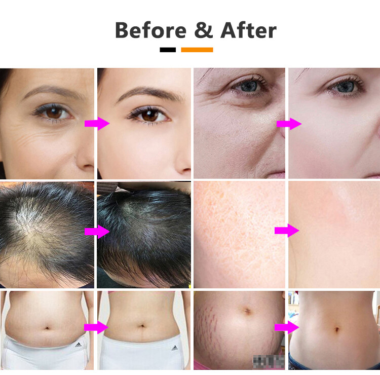 CDT Carboxy Therapy Portable CO2 Carboxytherapy Machine CO2 C2P Therapy ...