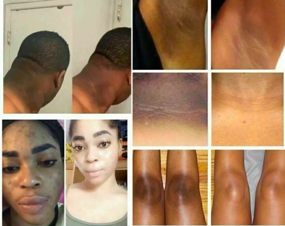 Dark Skin Bleaching Cream Whitening Lightening AHA - Face & Body |- 15g ...