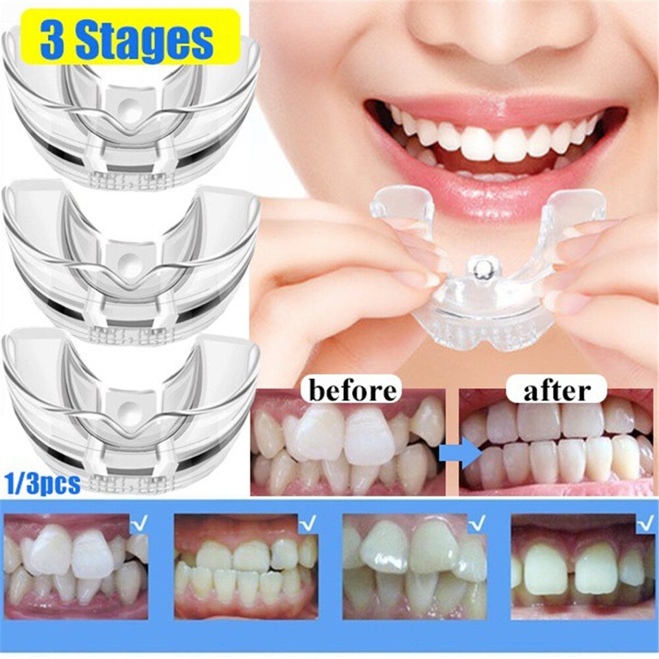 1+2+3 Stages Orthodontic Teeth Corrector Dental Braces Tooth Retainer ...