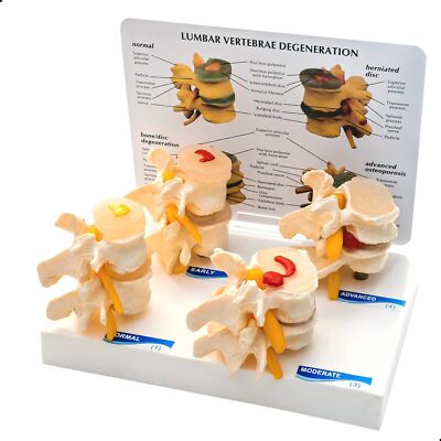 VERTEBRAE DEGENERATION MODEL ,4 STAGE DISC DEGENERATION SPINE MODEL PVC ...
