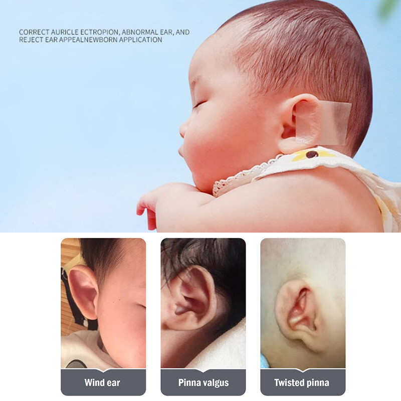Baby Ear Correctors Medical Silicone Tape Infant Ear Correction Pa-VF ...