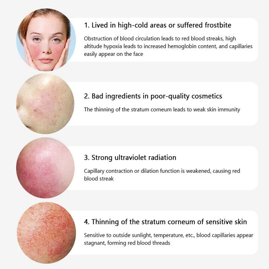 Physical Therapy Diode Laser 980nm Vascular Blood Removal Spider Vein ...