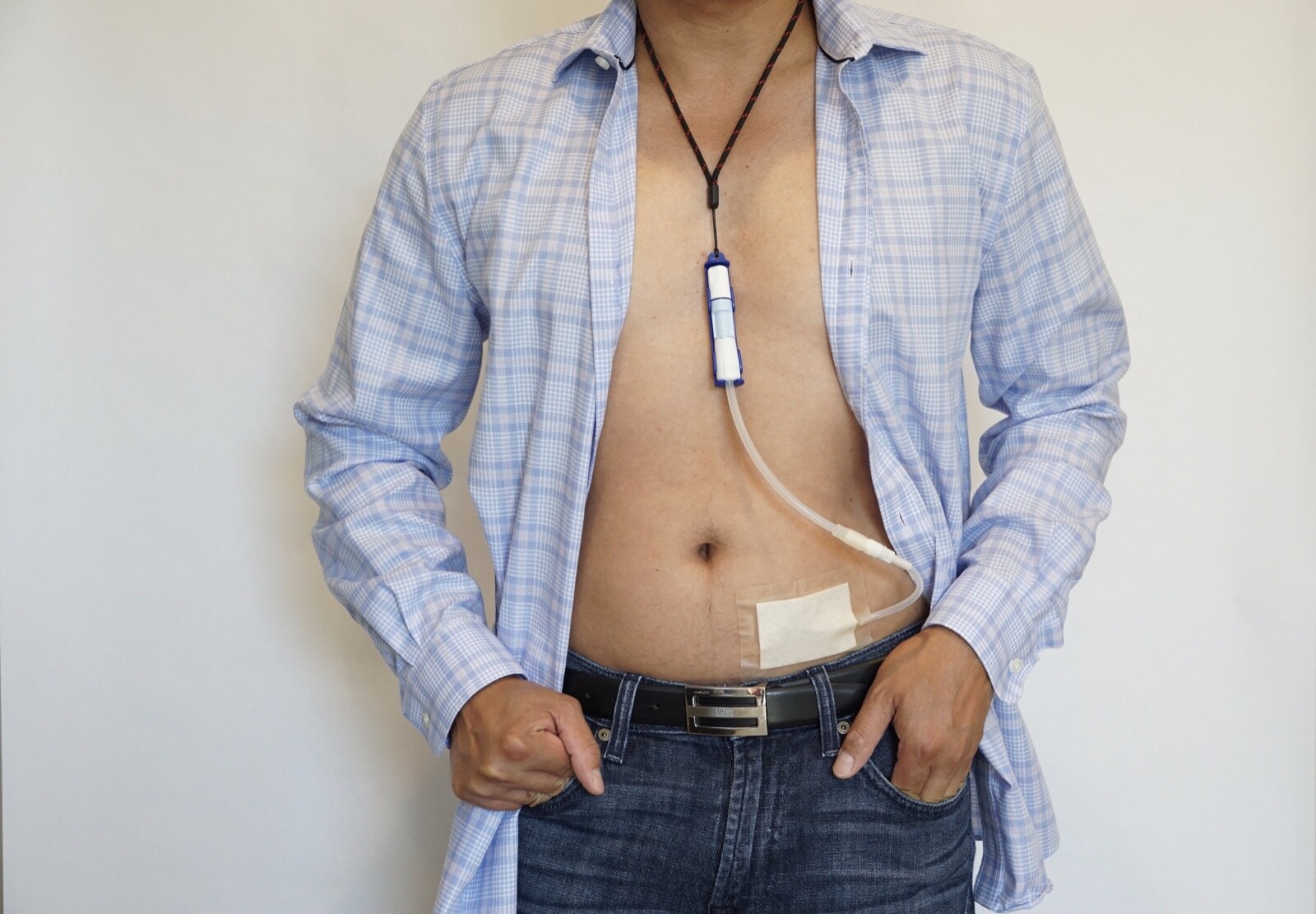 MandMcares Peritoneal Dialysis Belt-Holder for Baxter | PD Transfer Set ...