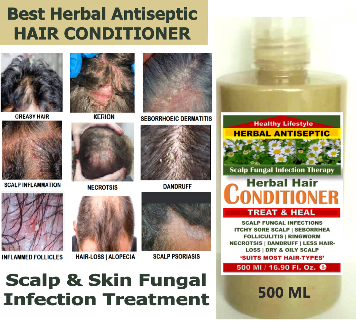 Impetigo Scalp
