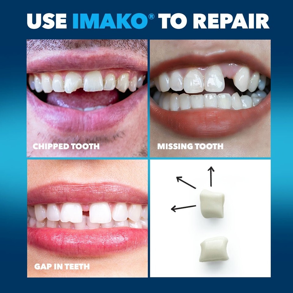 Imako® Tooth Tinted Plastic - Temporary Tooth - Fix Chipped Teeth, Gaps ...