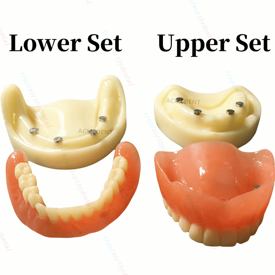 Dental Full Denture Model Overdenture Magnetic Attachment Mandibular ...