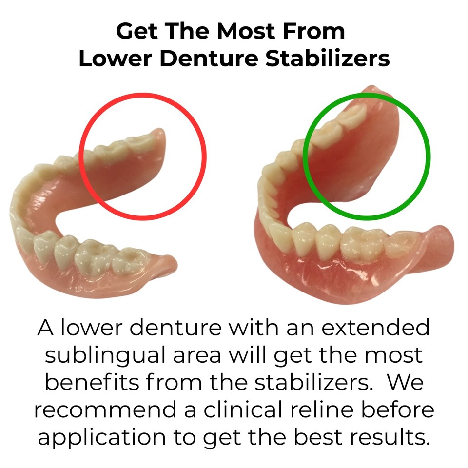 Lower Denture Stabilizers DIY Kit-Affordable Denture Stabilization | eBay