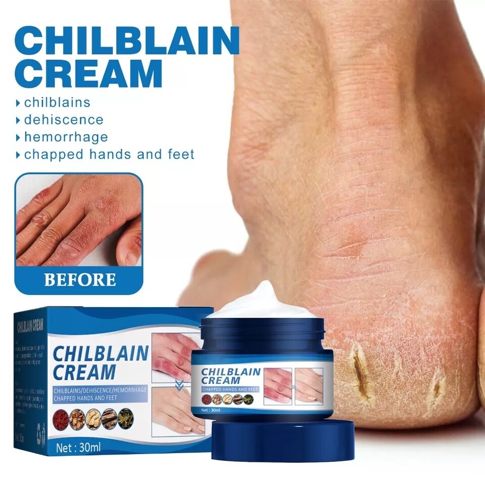 30ml Chilblain Cream Anti-cracking Frostbite Moisturiser Deep ...