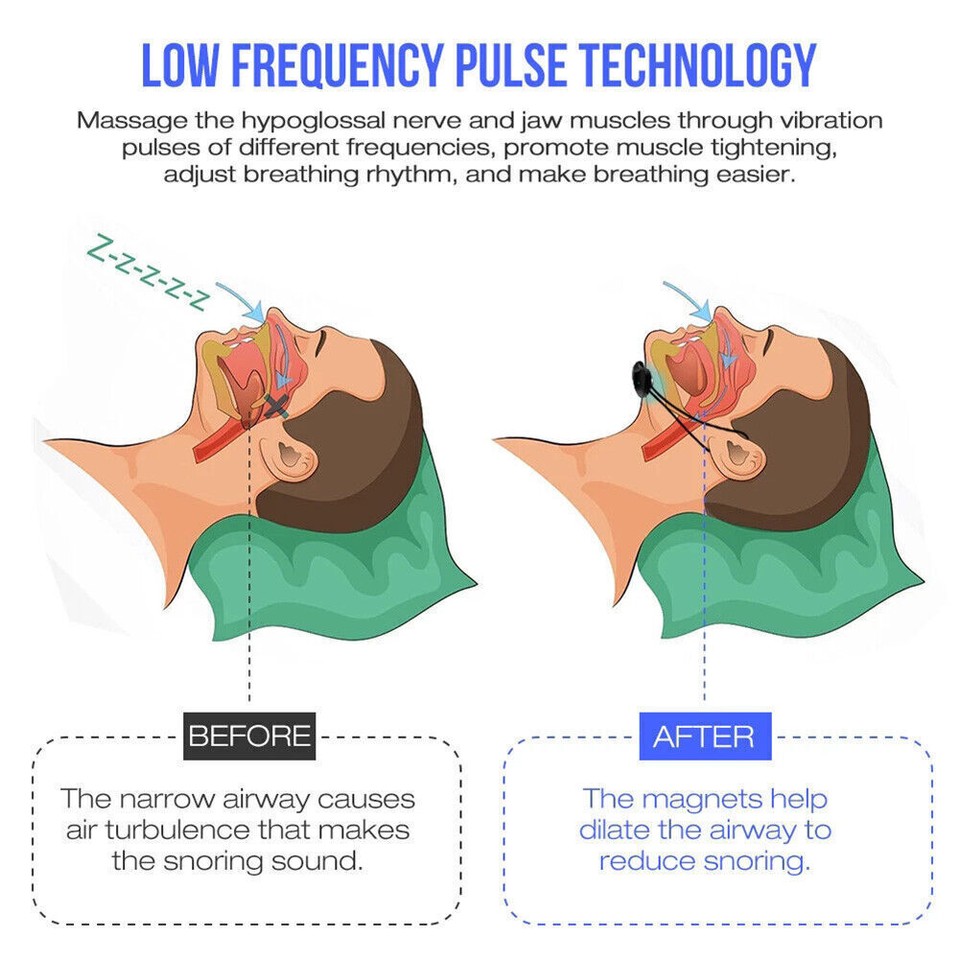 Anti Snoring Device Sleep Aid Smart Snore Stopper Electric Stop Snoring ...