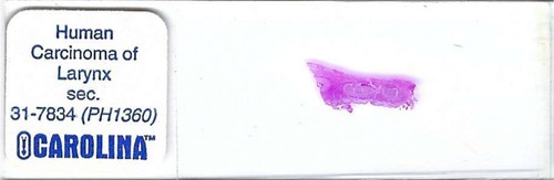 Human Carcinoma of Larynx Pathology Microscope Slide | eBay
