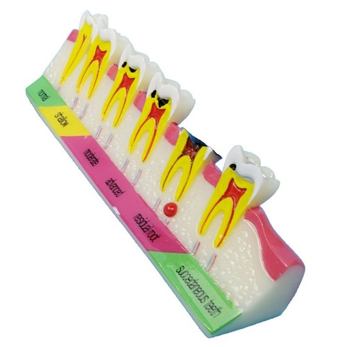 Dental Caries Classify Model Teeth Caries Evolution Decayed Tooth ...