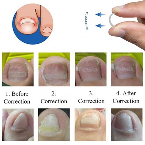 10 pieces/set of toenail correction patch bracket elastic patch nail ...