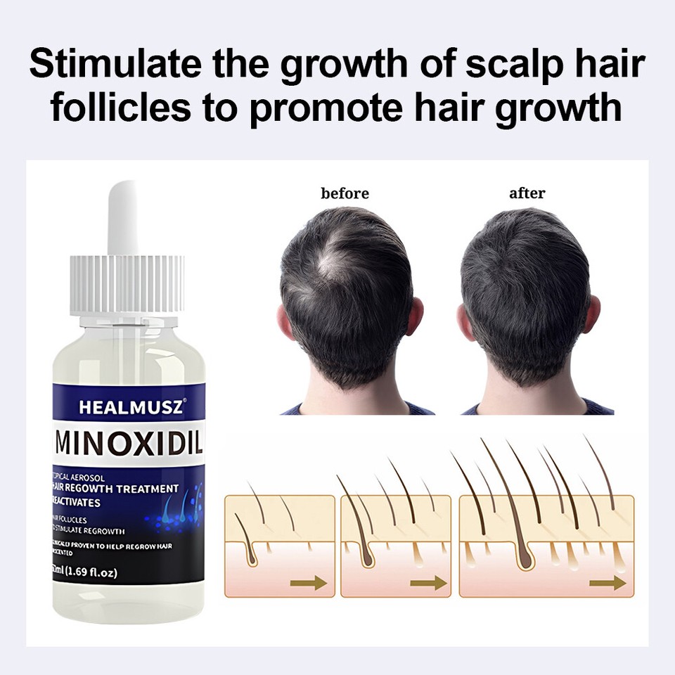 Minoxidil 5% Topical Solution for Men Hair Regrowth, Anti Hair Loss ...
