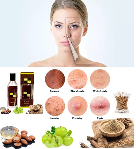 Medicated Lotion to Clear Pimples and Blackheads All Natural Nut Grass ...