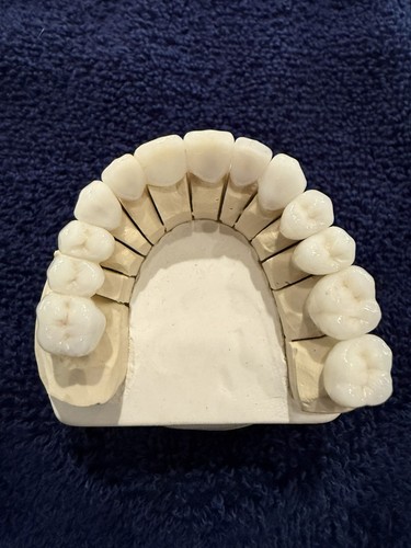 Dental Study Model With Crowns Sample | eBay