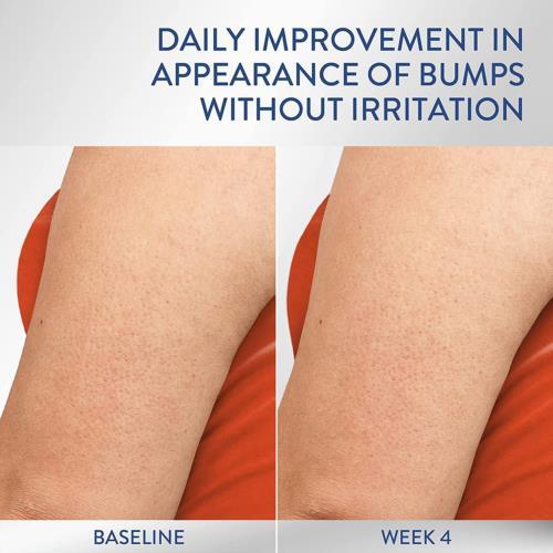 CETAPHIL Daily Smoothing Moisturizer for Rough and Bumpy Skin | 10 fl ...