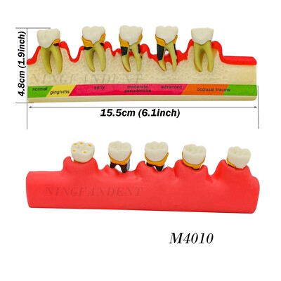 Dental Typodont Periodontal Disease Teeth Model Stage Perio Disease ...