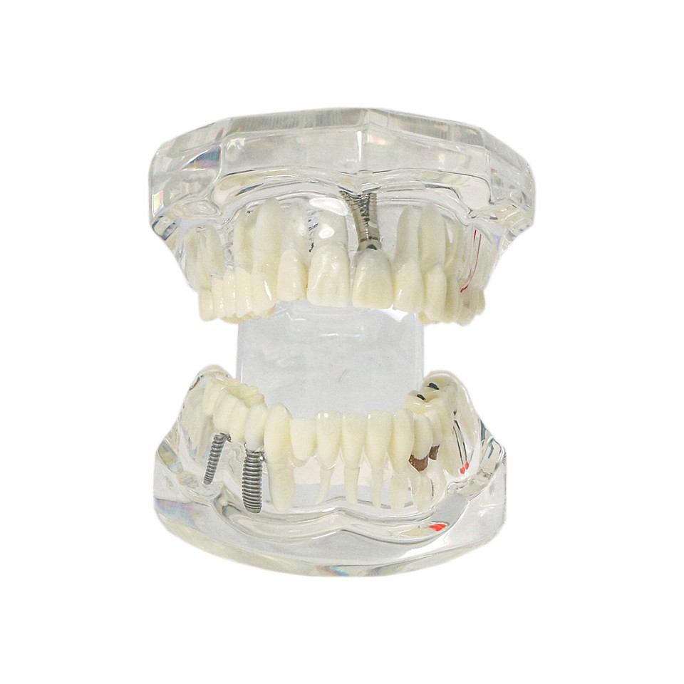 Dental Implant Teeth Model Teach Study Demo Restoration Pathology ...