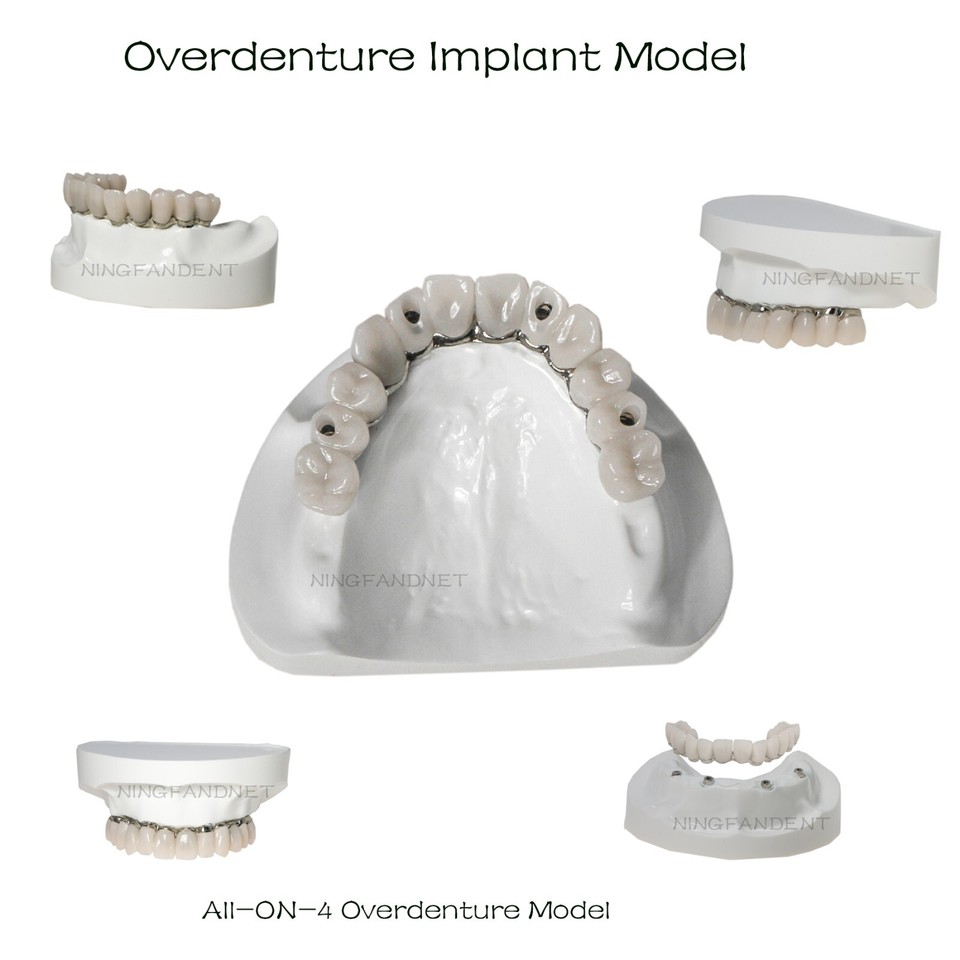 Dental All-On-4 Overdenture Implant Model Upper Pure Titanium Bridge, 4 ...