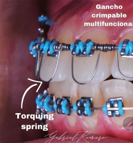 Dental Orthodontic Torquing Torque Spring Rectangular wire Single ...