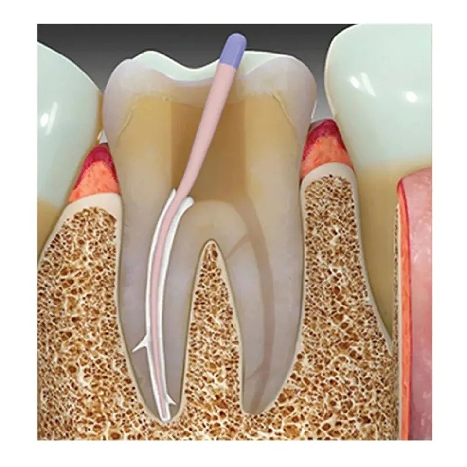 PREVEST DENPRO CALAPEX ROOT CANAL SEALER (Manual-Mix) | eBay