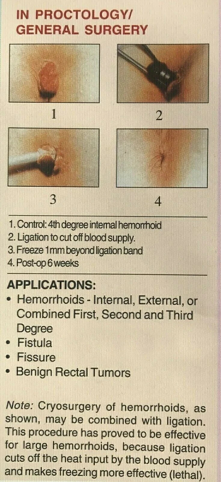 Cryogun Cryo Surgical Gun Otorhinolaryngology Gynecology With One Probe ...