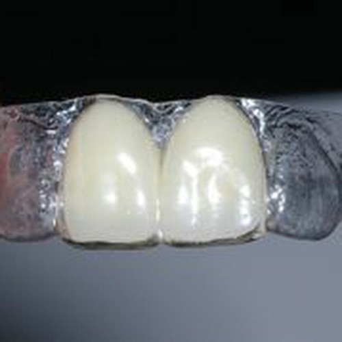 Temporary Replacement (3) teeth in Crystal Clear Retainer, for Upper OR ...