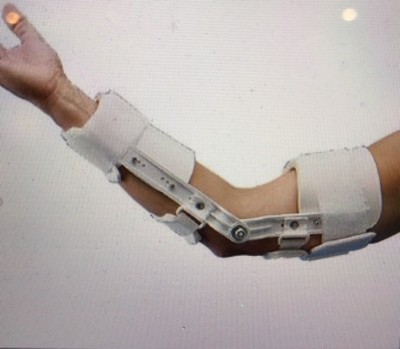 Rolyan Smith/Nephew Preformed Elbow Hinge Splint A517, LOWEST PRICE ...