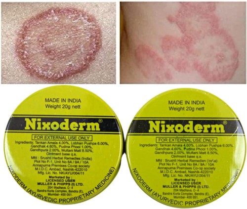 Nixoderm 20gm Cream Treat Skin Infections, Eczema, Pimples, Blemishes ...