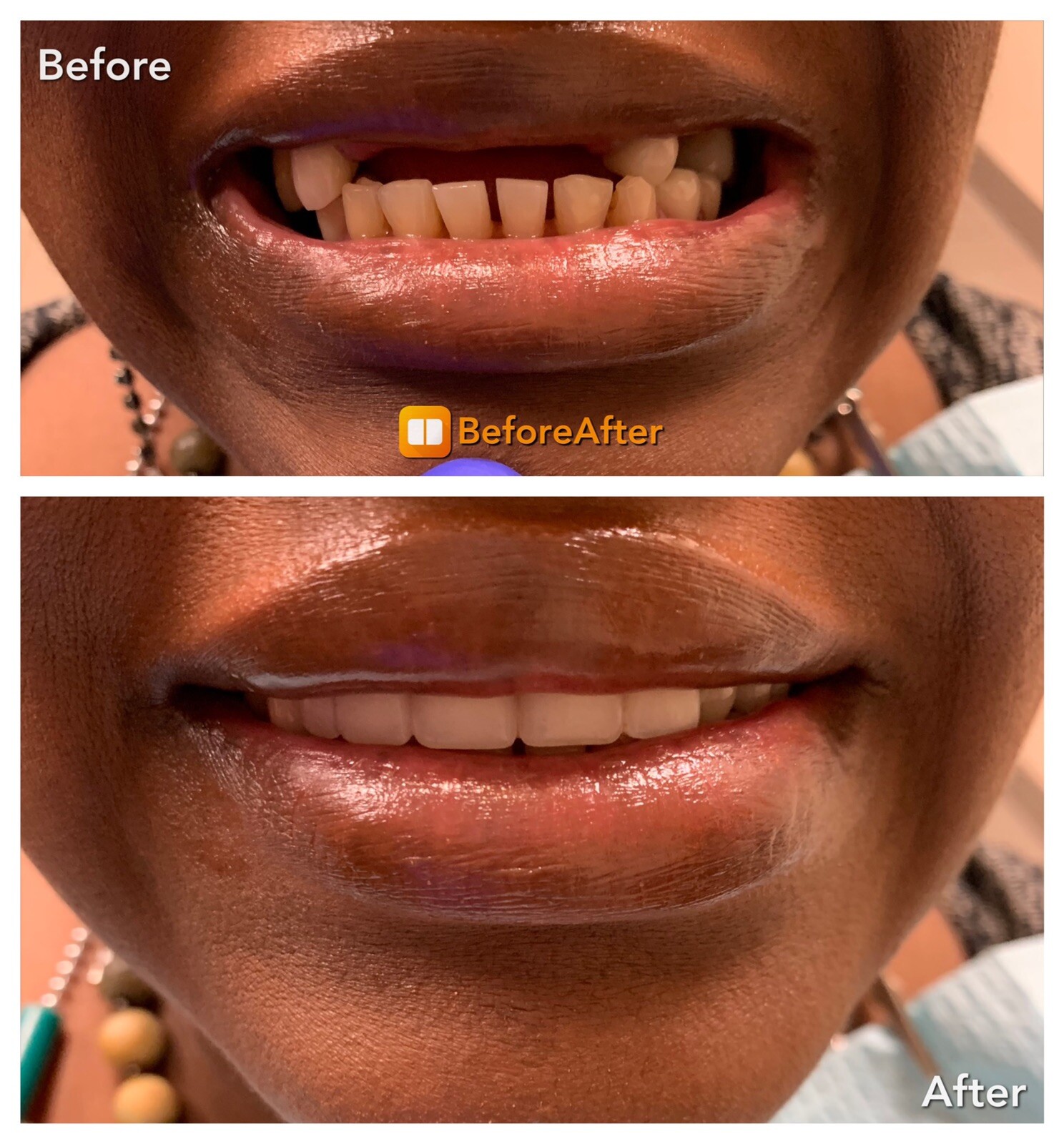 denture,partial,flipper,stayplate,nightguard,sportguard,retainer ...