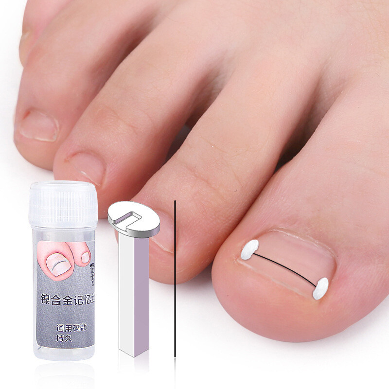 1pcs Toenail Straightening Clip Ingrown Toenail Correction Nail Patch ...